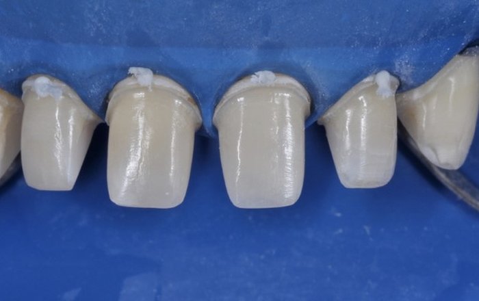 Mastering Tooth Preparation & Bonding of Ceramic Restorations Crowns ...