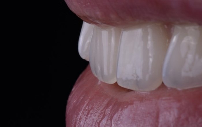 Mastering Tooth Preparation & Bonding of Ceramic Restorations Crowns ...