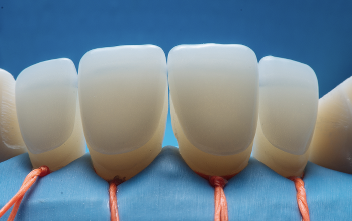 Microvision Aesthetics All About Veneers: Full Course From Digital ...