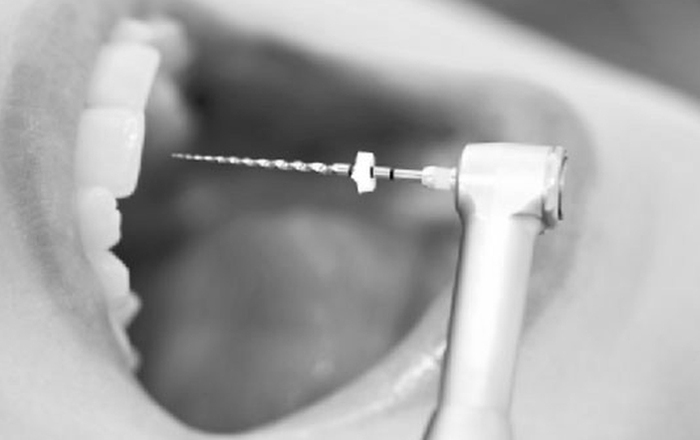 Effective "Tips" for Success in Endodontics | Dental ED