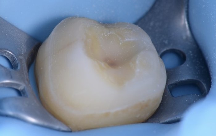 Mastering Tooth Preparation & Bonding of Ceramic Restorations Crowns ...