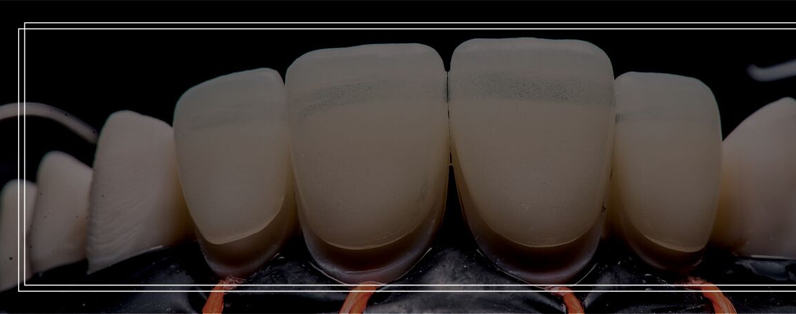 Mastering Tooth Preparation & Bonding of Ceramic Restorations Crowns ...