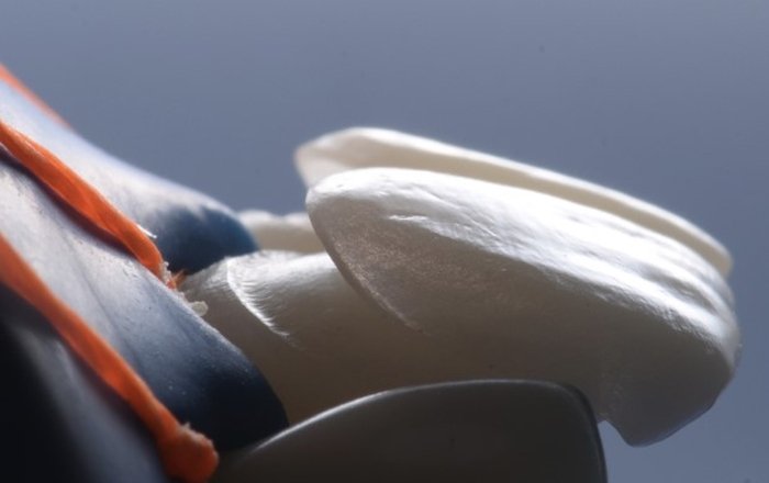 Mastering Tooth Preparation & Bonding of Ceramic Restorations Crowns ...