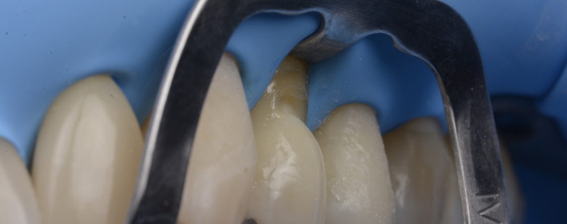 Style Italiano: Layers, The Complete Composite Course | Dental ED