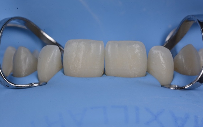 Style Italiano: Layers, The Complete Composite Course | Dental ED